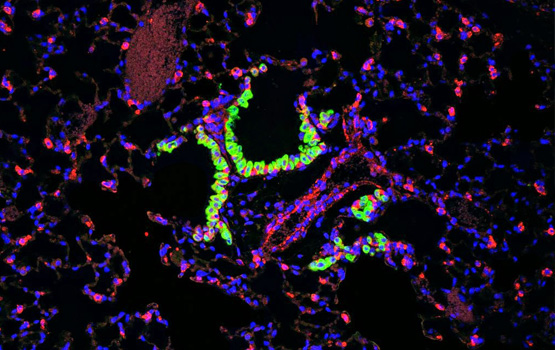 Stem cell therapy discovery brings lung disease treatment closer ...